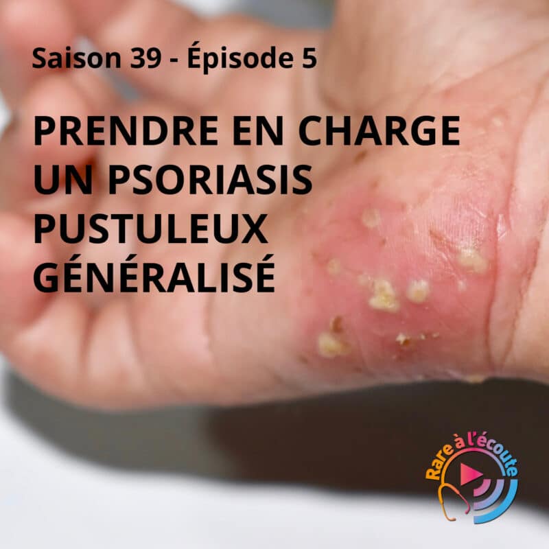 Psoriasis Pustuleux Généralisé – Prise en charge